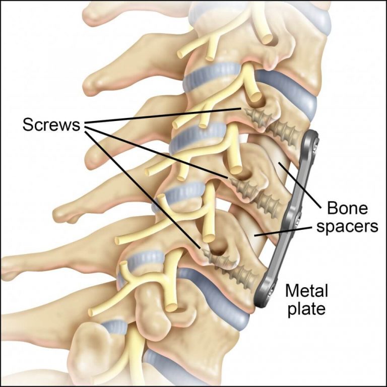 Cervical Fusion Spine And Orthopedic Specialists Neo Surgical Group 